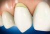 Dental Abrasion: What is it and do You Need it? - Ascent Family Dental